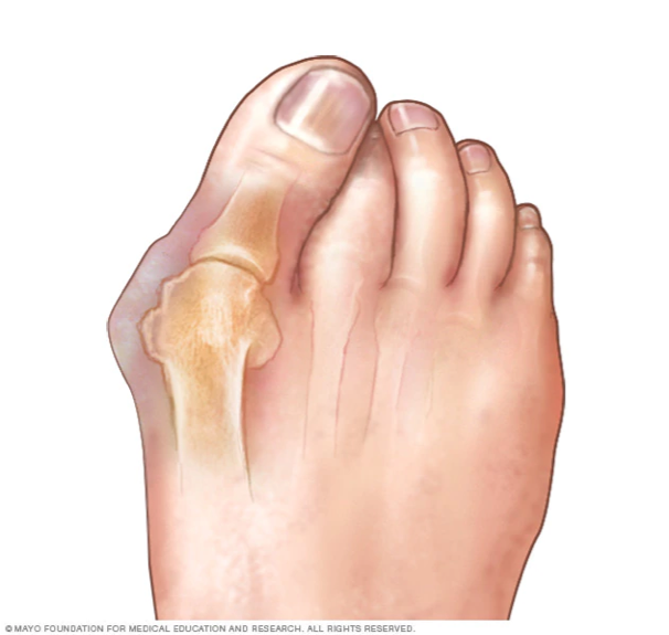 How Do You Know You Have Bunions? - FeetCare